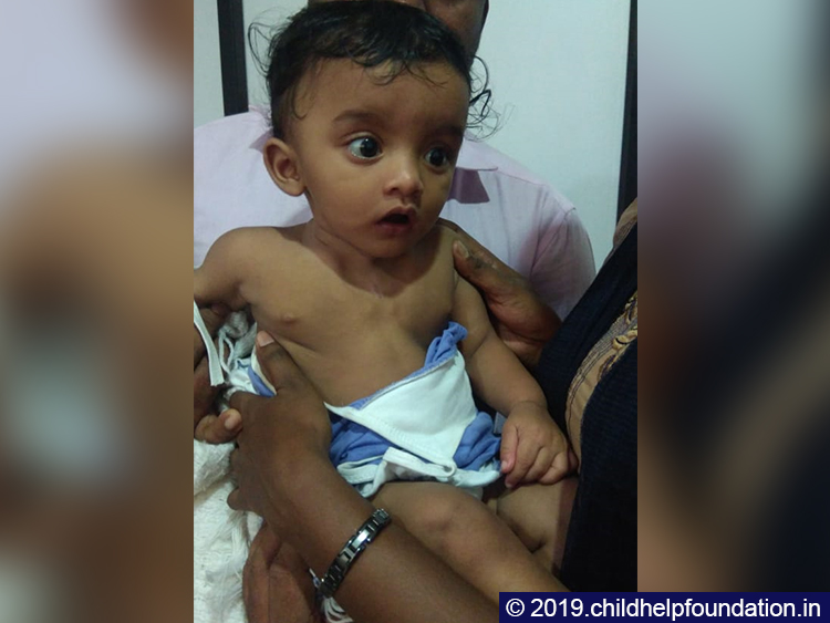 8-months-old Athmika Needs Complete Sternal Reconstruction with 3 weeks ...
